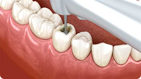 Dental Fillings - Martindale Dental