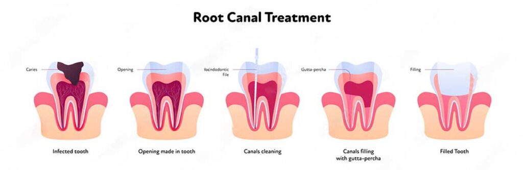 Root Canal - Martindale Dental