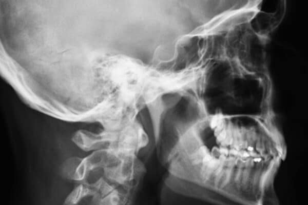 Dental X-Rays - Martindale Dental