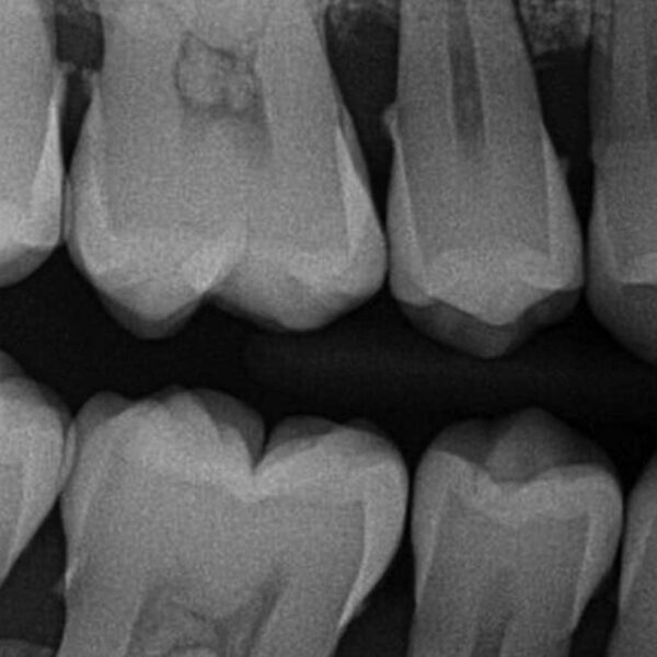 Dental X-Rays - Martindale Dental