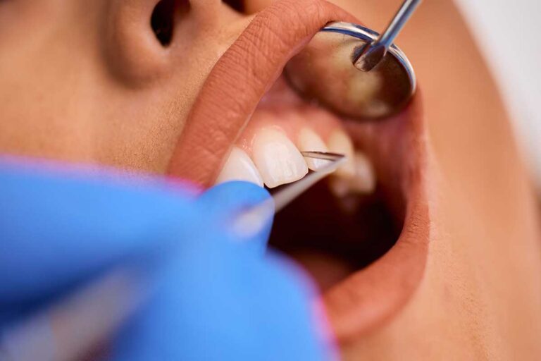 Can I remove plaque from my teeth at home? - Martindale Dental
