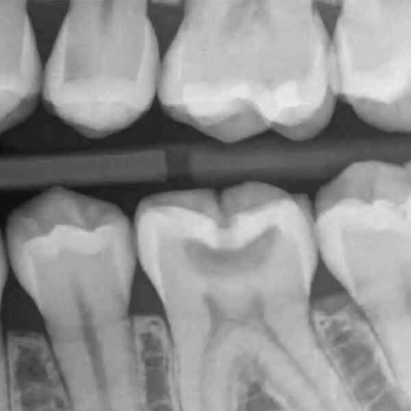 Dental X-Rays - Martindale Dental