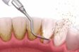 Can I remove plaque from my teeth at home? - Martindale Dental