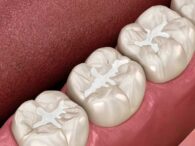 Complete Guide to Dental Fillings: Types, Procedures, and Care ...