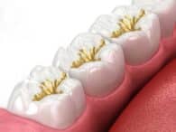 Complete Guide to Dental Fillings: Types, Procedures, and Care ...