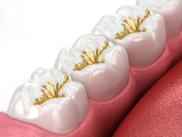 Complete Guide to Dental Fillings: Types, Procedures, and Care ...