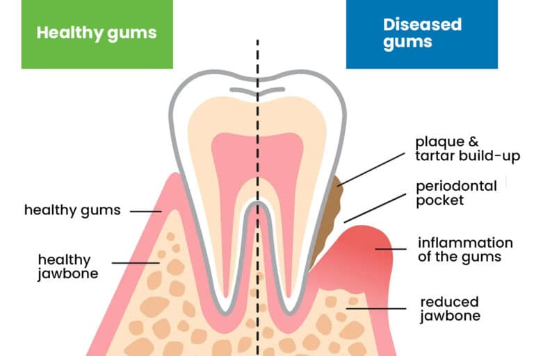Why Do My Gums Bleed When I Brush My Teeth? - Martindale Dental