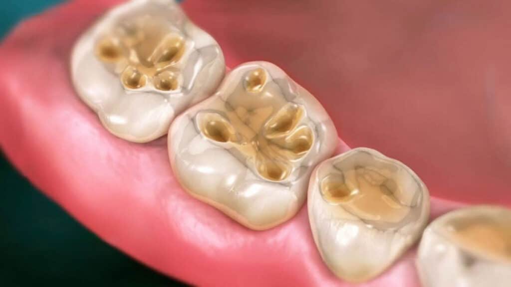 How Does Acid Reflux Affect Your Teeth? 5 Key Impacts - Martindale Dental