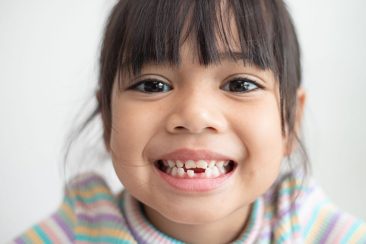 When To Use Space Maintainers For Kids - Martindale Dental