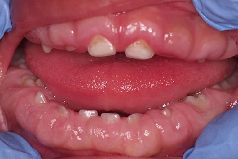 Gingival Hyperplasia in Toddlers & Children: Causes, Symptoms, and ...